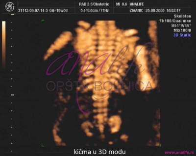 Ekspertski 4D ultrazvuk od 14-19. nedelje trudnoće :: Opšta Bolnica Analife