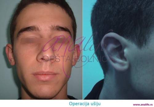 Operacija i korekcija ušiju, klempavih i asimetričnih - Opšta Bolnica ...