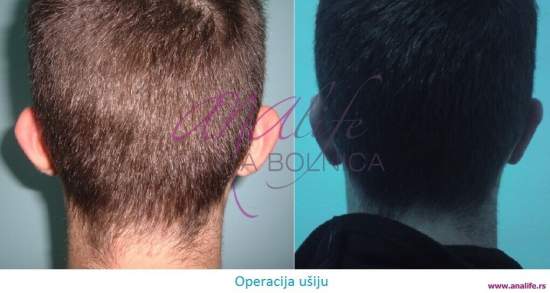 Operacija i korekcija ušiju, klempavih i asimetričnih - Opšta Bolnica ...