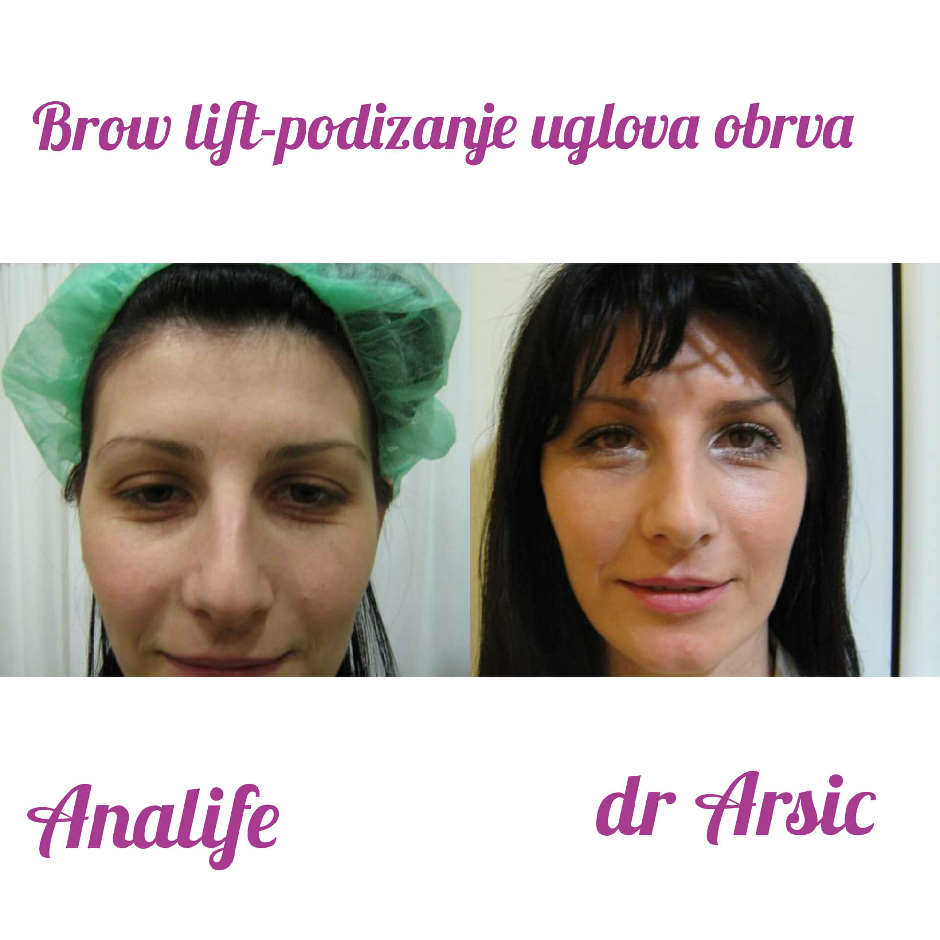 Brow lift - Podizanje obrva i zatezanje čela - Opšta Bolnica Analife
