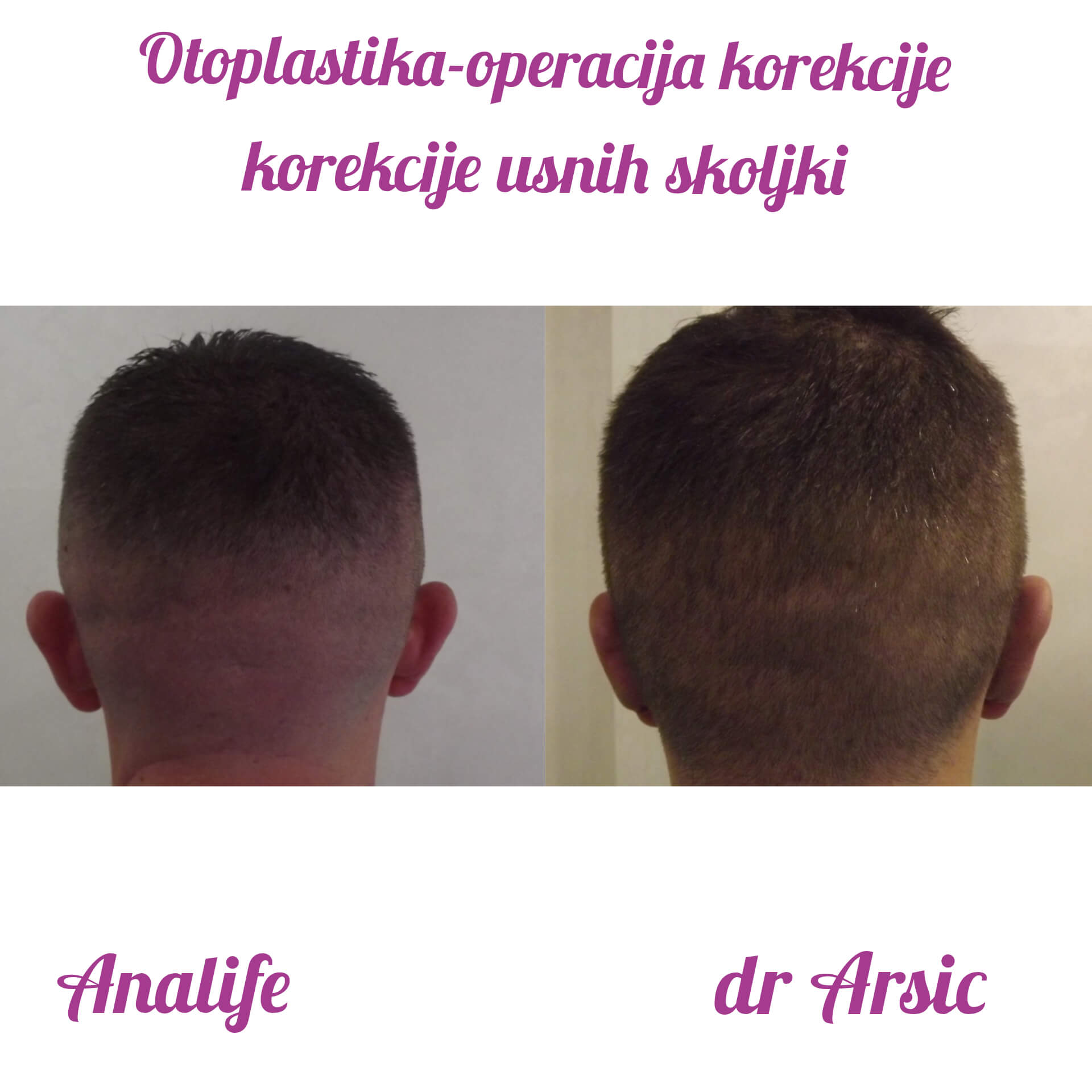 Operacija i korekcija ušiju, klempavih i asimetričnih - Opšta Bolnica ...