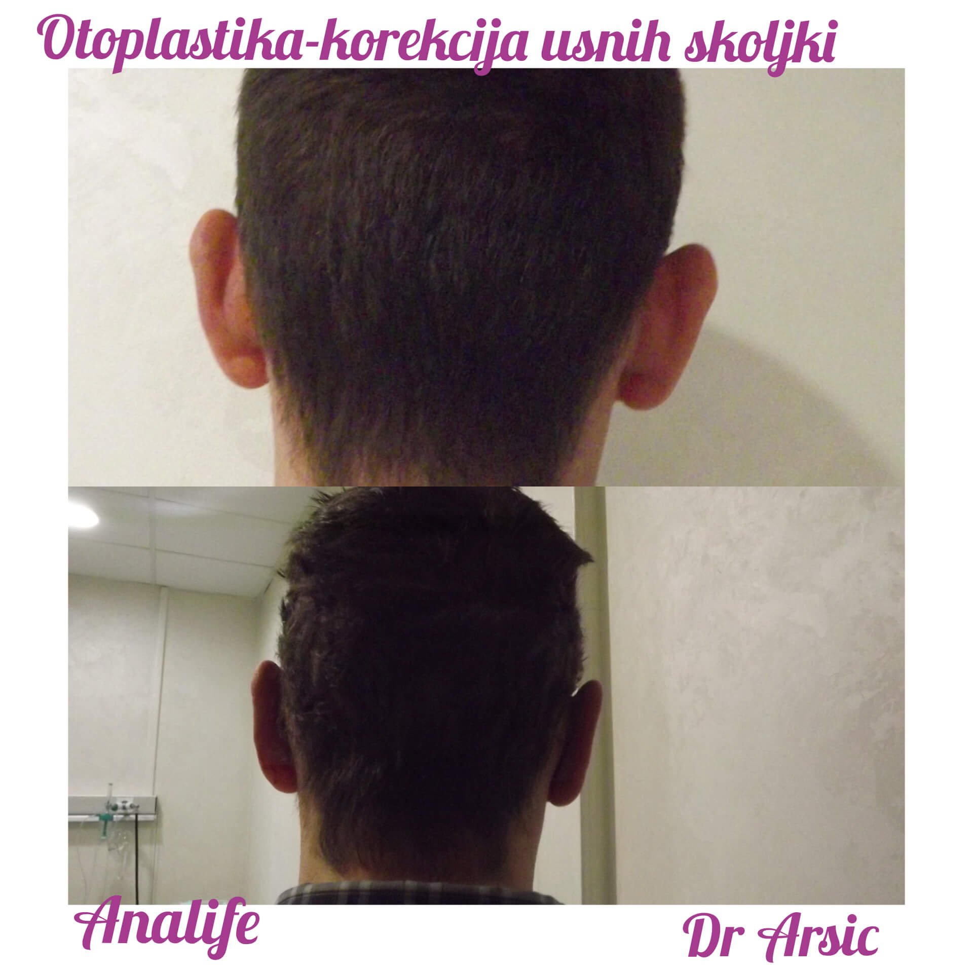 Operacija i korekcija ušiju, klempavih i asimetričnih - Opšta Bolnica ...